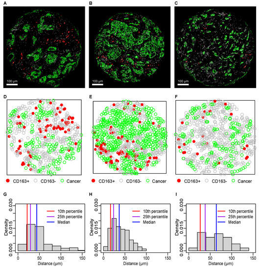 Spatial Metrics of Interaction between CD163-Positive Macrophages and ...