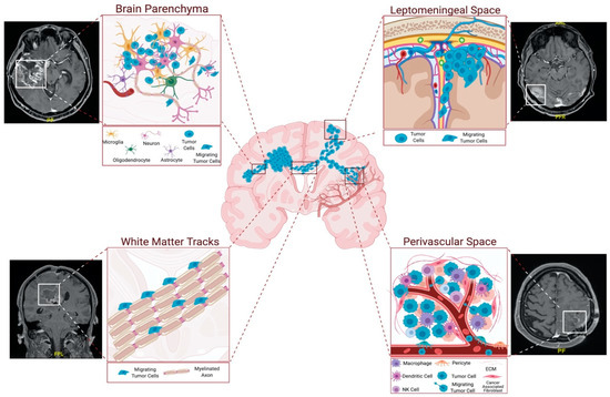 Tumor Cell Infiltration into the Brain in Glioblastoma: From Mechanisms ...