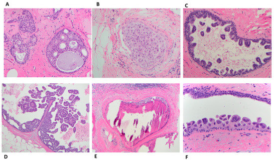 Preneoplastic Low-Risk Mammary Ductal Lesions (Atypical Ductal ...