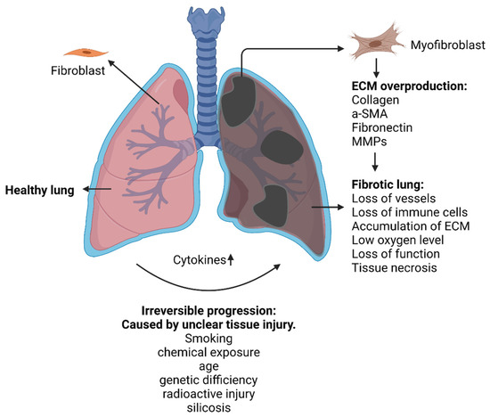 Inflammation, Fibrosis and Cancer: Mechanisms, Therapeutic Options and ...