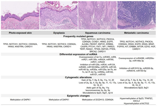 Squamous Cell Carcinoma Histology Ear