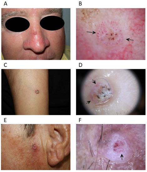 Update on Management Recommendations for Advanced Cutaneous Squamous ...