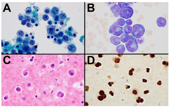 Primary Effusion Lymphoma: A Clinicopathologic Perspective