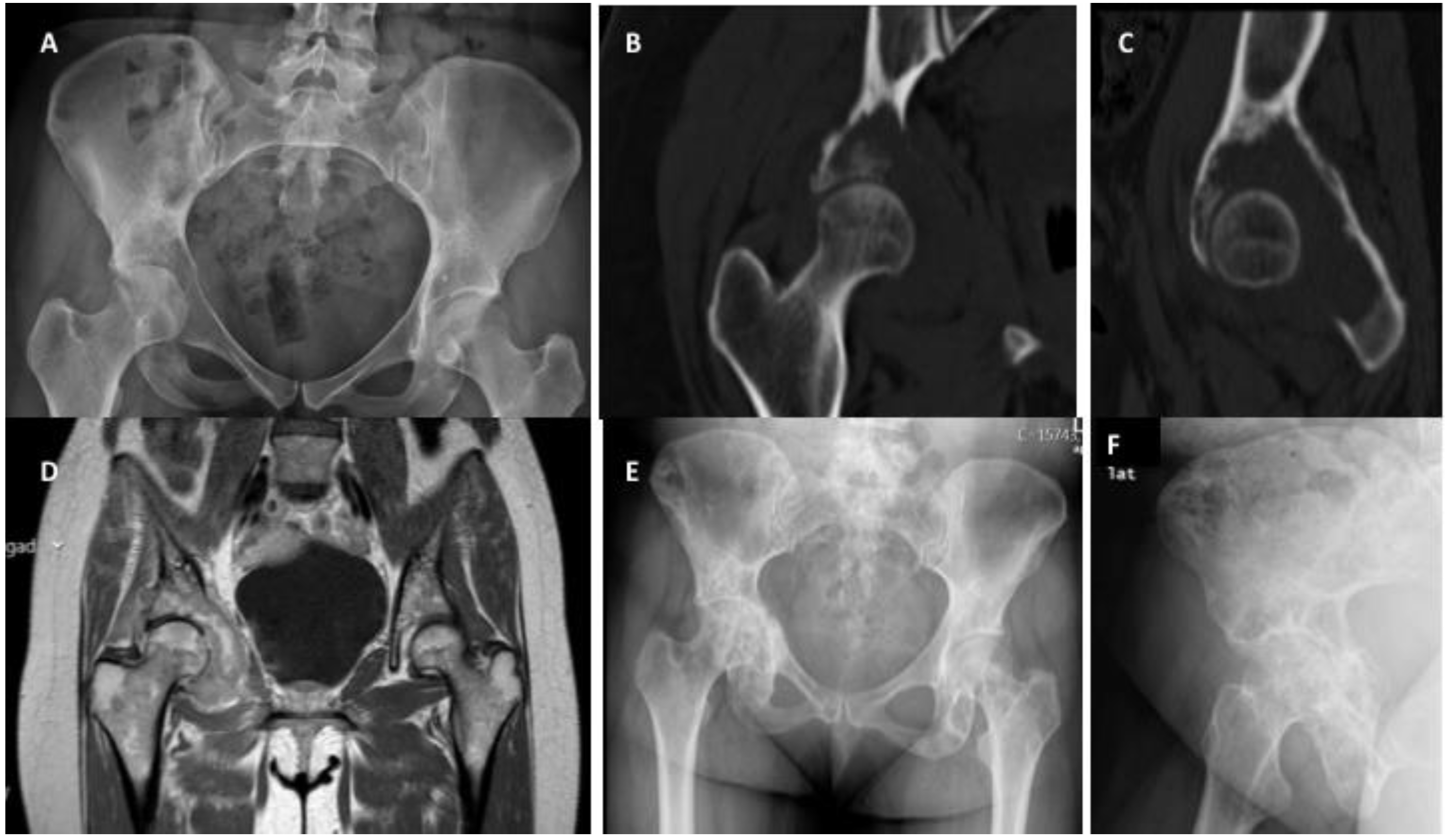 A Tailored Approach for Appendicular Impending and Pathologic Fractures ...