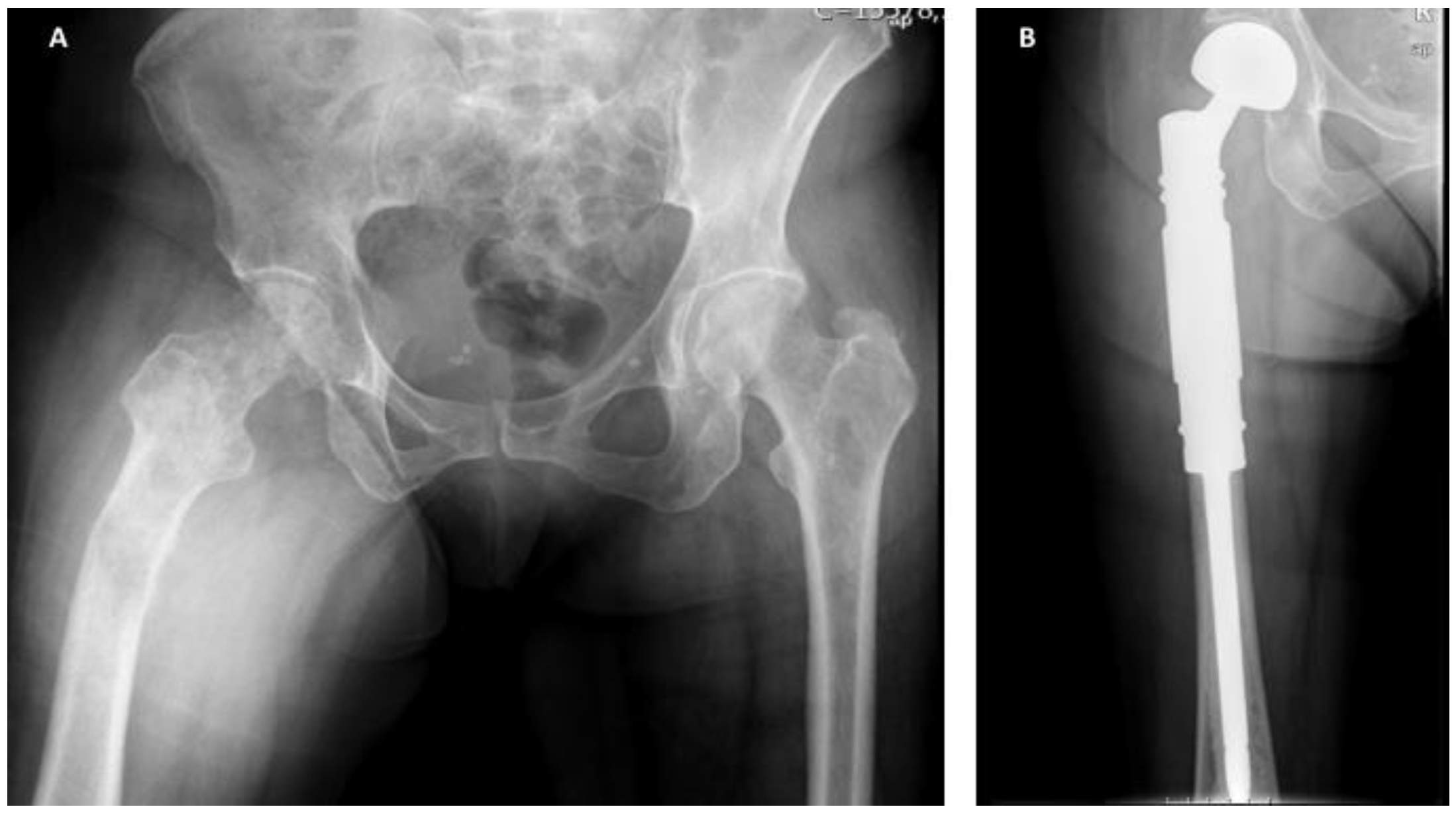 Pathologic Fracture X Ray