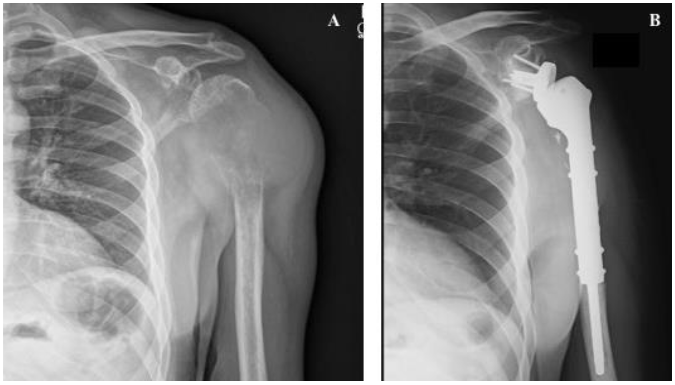 Pathologic Fracture X Ray