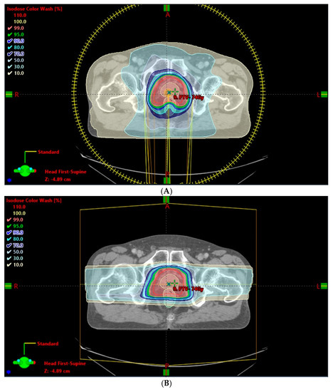 Radiation Therapy Imrt Prostate Cancer