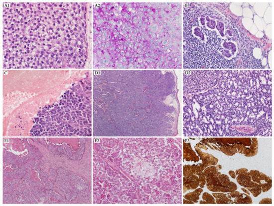 Treatment of Malignant Adnexal Tumors of the Skin: A 12-Year Perspective