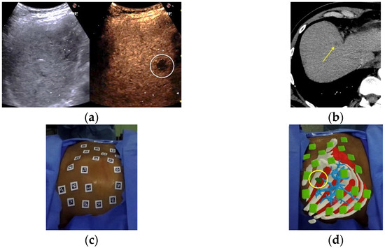 Thermal Ablation of Liver Tumors Guided by Augmented Reality: An ...