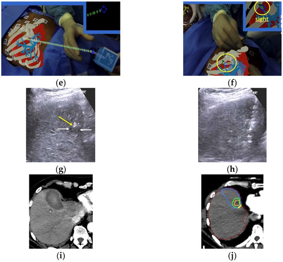 Thermal Ablation of Liver Tumors Guided by Augmented Reality: An ...
