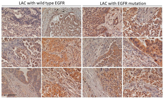 EGFR Mutation-Harboring Lung Cancer Cells Produce CLEC11A with ...