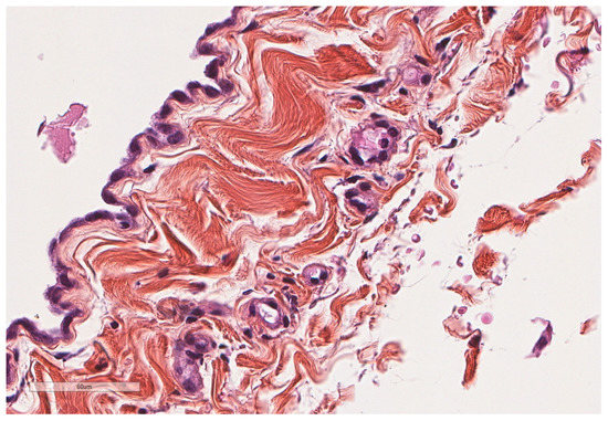 Inflammation of the Pleural Cavity: A Review on Pathogenesis, Diagnosis ...