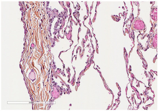 Inflammation of the Pleural Cavity: A Review on Pathogenesis, Diagnosis ...