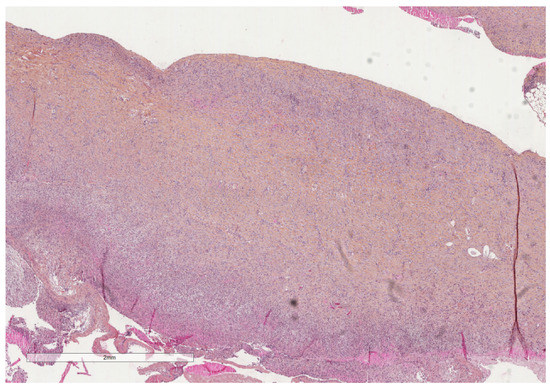 Inflammation of the Pleural Cavity: A Review on Pathogenesis, Diagnosis ...