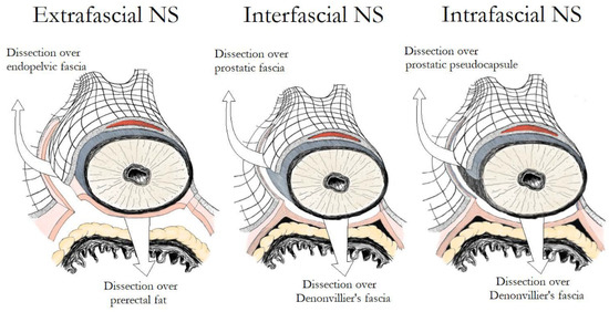Cancers Free Full Text Different Nerve Sparing Techniques During