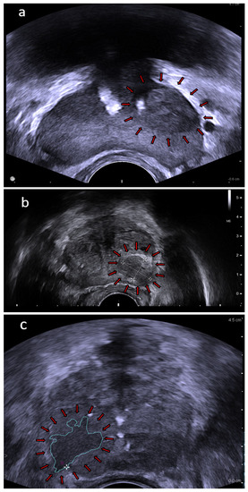 Alternatives for MRI in Prostate Cancer Diagnostics—Review of Current ...