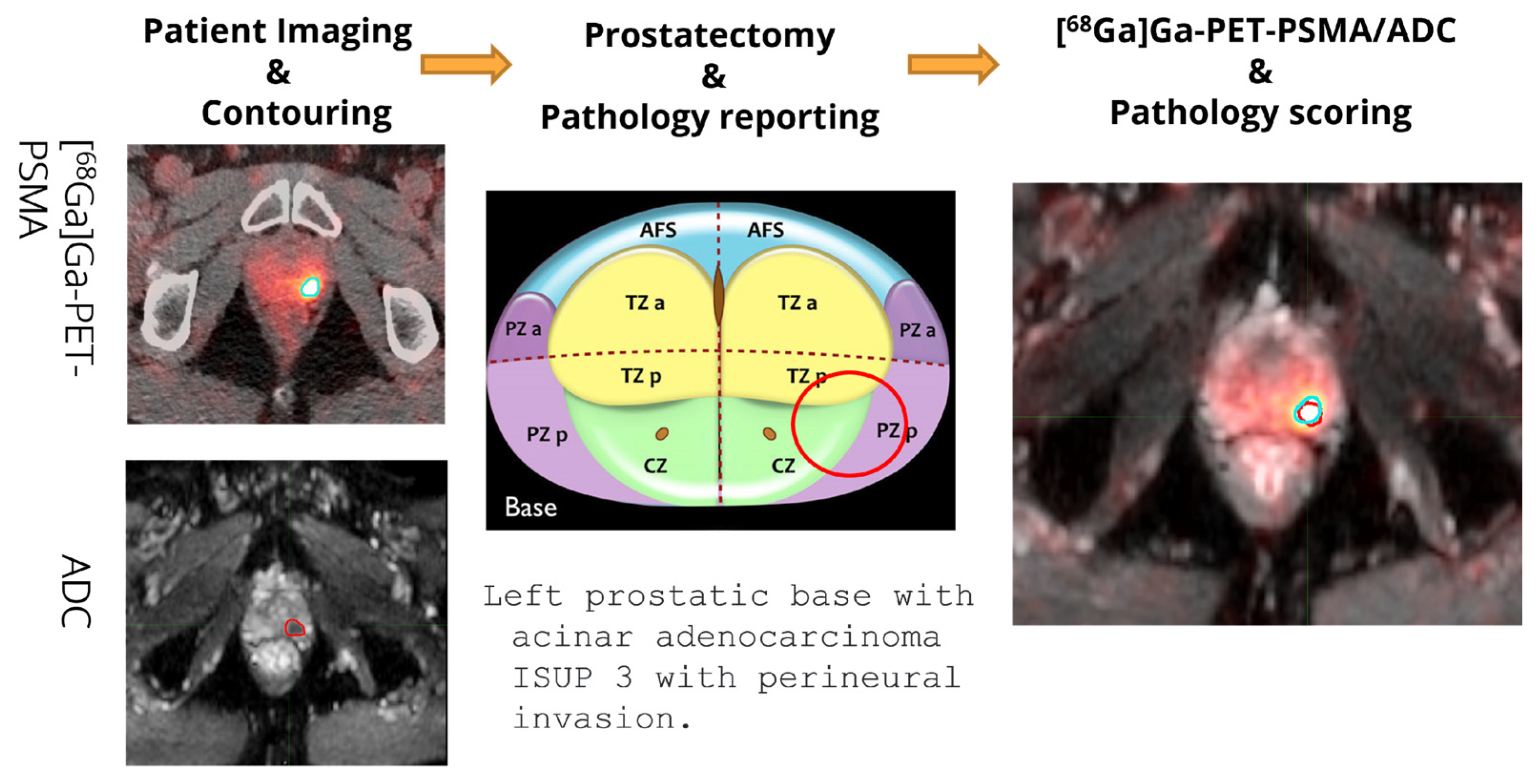 Cancers | Free Full-Text | Radiomics Analysis on [68Ga]Ga-PSMA-11 PET and MRI-ADC for the ...