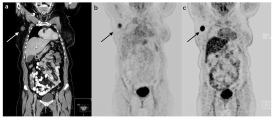 Cancers | Free Full-Text | Clinical Evaluation of Nuclear Imaging ...