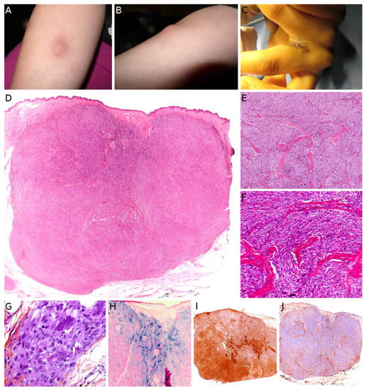 Cancers | Special Issue : Rare Skin Cancers: Recent Advances in ...