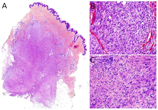 Cancers | Special Issue : Rare Skin Cancers: Recent Advances in ...