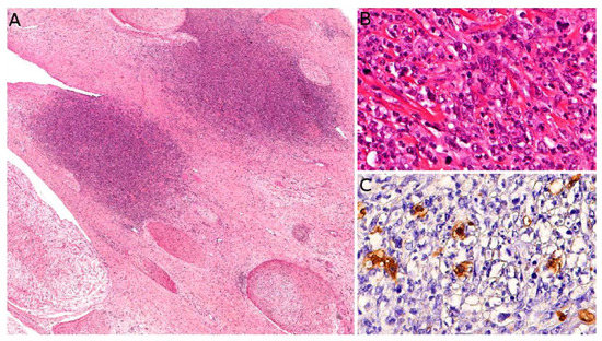 Cancers | Special Issue : Rare Skin Cancers: Recent Advances in ...