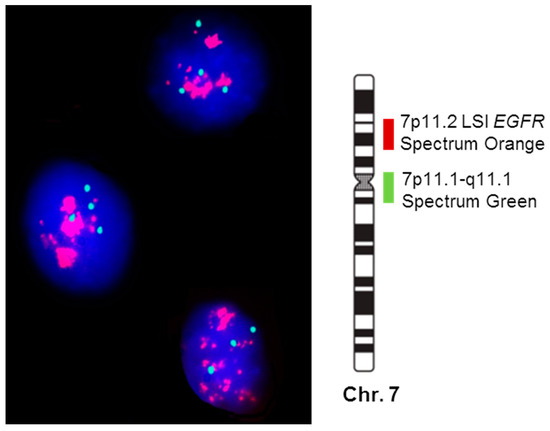 Prognostic Impact of EGFR Amplification and Visceral Pleural Invasion ...