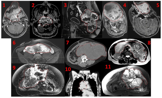 Novel Carbon Ion and Proton Partial Irradiation of Recurrent Unresectable Bulky Tumors (Particle ...