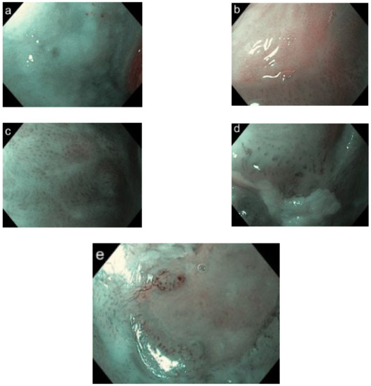 Diagnostic Accuracy of High-Grade Intraepithelial Papillary Capillary ...