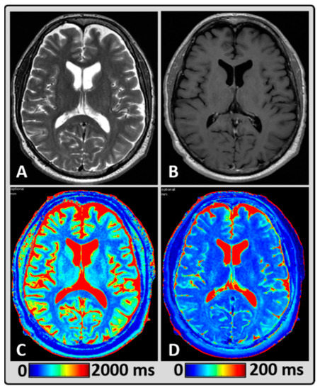 Ms Mri Brain Scan Results