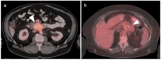 PET-CT in Clinical Adult Oncology: III. Gastrointestinal Malignancies