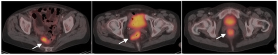 PET-CT in Clinical Adult Oncology: III. Gastrointestinal Malignancies