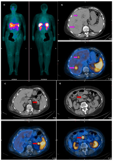 The New Radiolabeled Peptide 99mTcEDDA/HYNIC-TOC: Is It a Feasible ...
