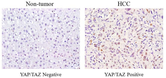 Anti-Cancer Effects of YAP Inhibitor (CA3) in Combination with ...