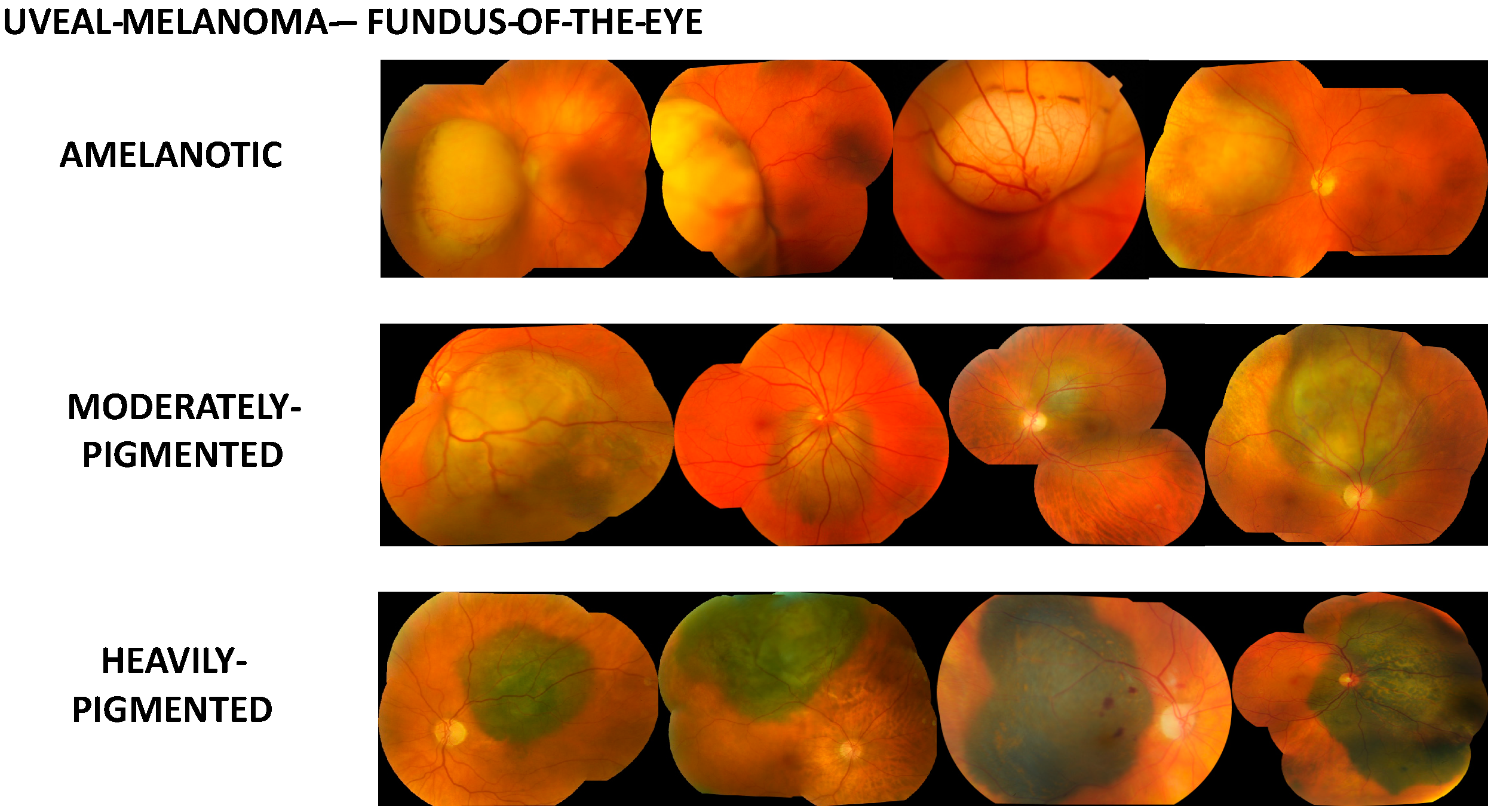 Melanoma Coroidal Amelanotico