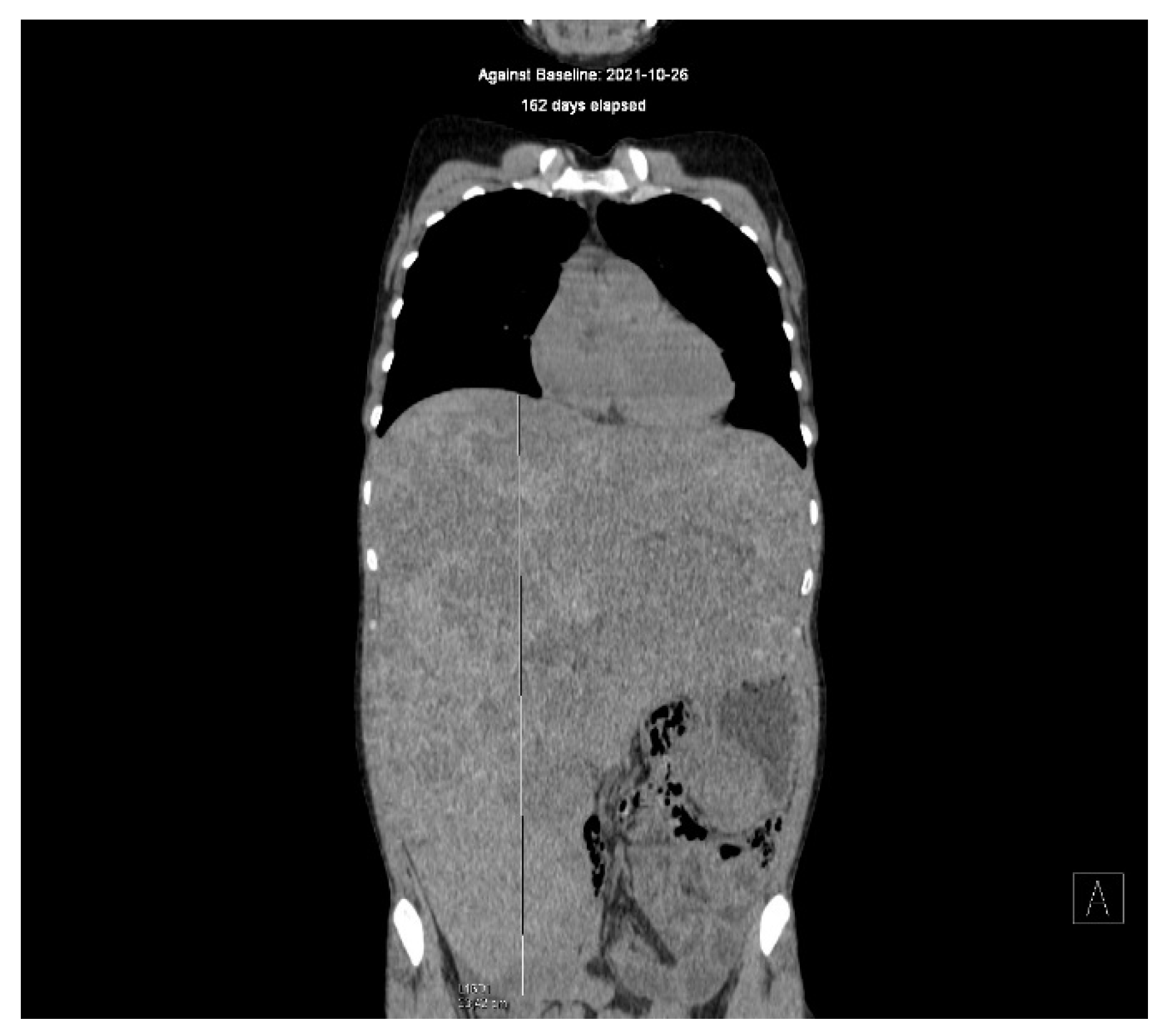 Treatment of Gastrointestinal Stromal Tumors (GISTs): A Focus on ...