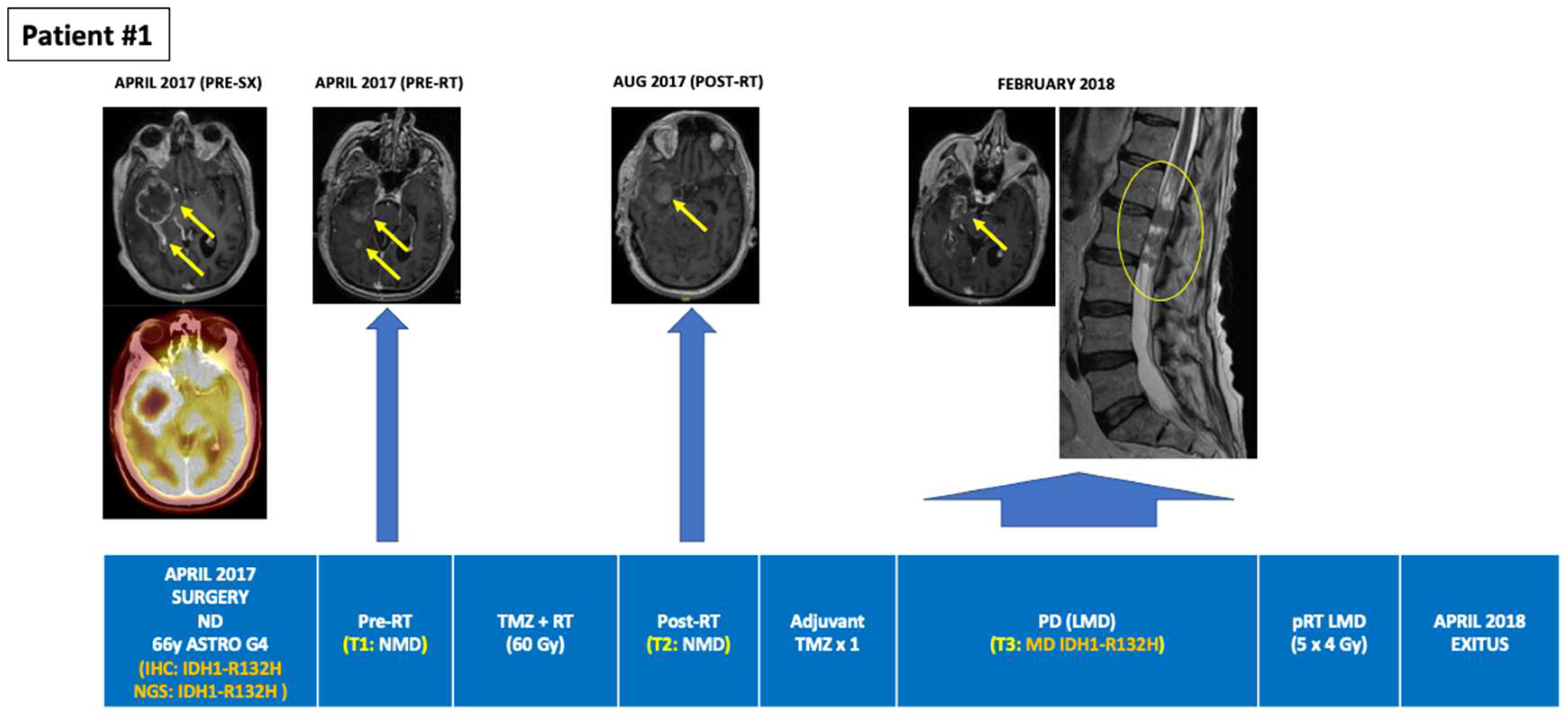 Cancers | Free Full-Text | Detection of IDH1 Mutations in Plasma Using BEAMing Technology in ...