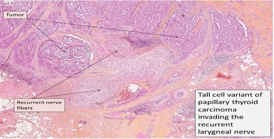 Cancers | Special Issue : Advances in the Management of Thyroid Cancer