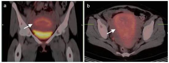 PET-CT in Clinical Adult Oncology—IV. Gynecologic and Genitourinary ...