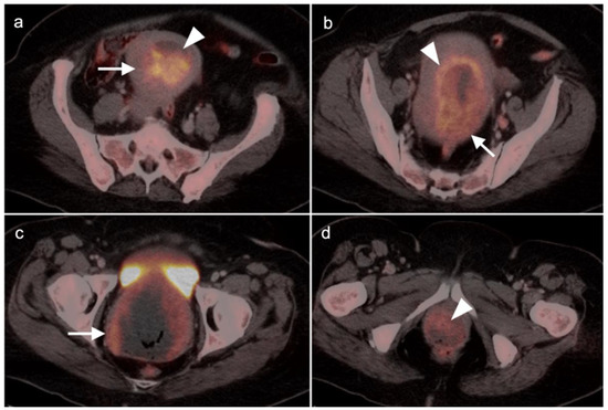 PET-CT in Clinical Adult Oncology—IV. Gynecologic and Genitourinary ...