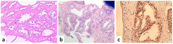 Cribriform Patterned Lesions in the Prostate Gland with Emphasis on ...