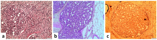 Cribriform Patterned Lesions in the Prostate Gland with Emphasis on ...