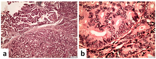 Cribriform Patterned Lesions in the Prostate Gland with Emphasis on ...