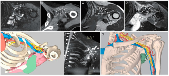 Preoperative Planning Using Three-Dimensional Multimodality Imaging for ...