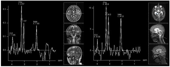 Magnetic Resonance Spectroscopy in Diagnosis and Follow-Up of Gliomas ...