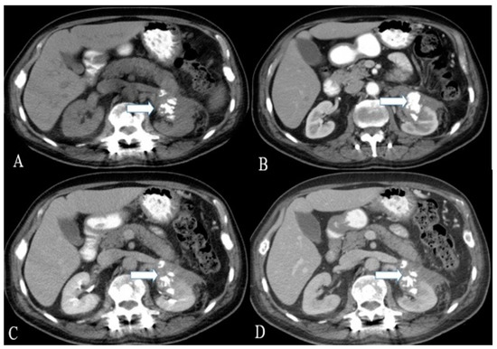 Neuroendocrine Neoplasms of the Female Genitourinary Tract: A ...