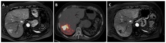 Cancers | Free Full-Text | The Evolving Role of Radioembolization in ...