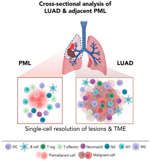 Cell-by-Cell: Unlocking Lung Cancer Pathogenesis