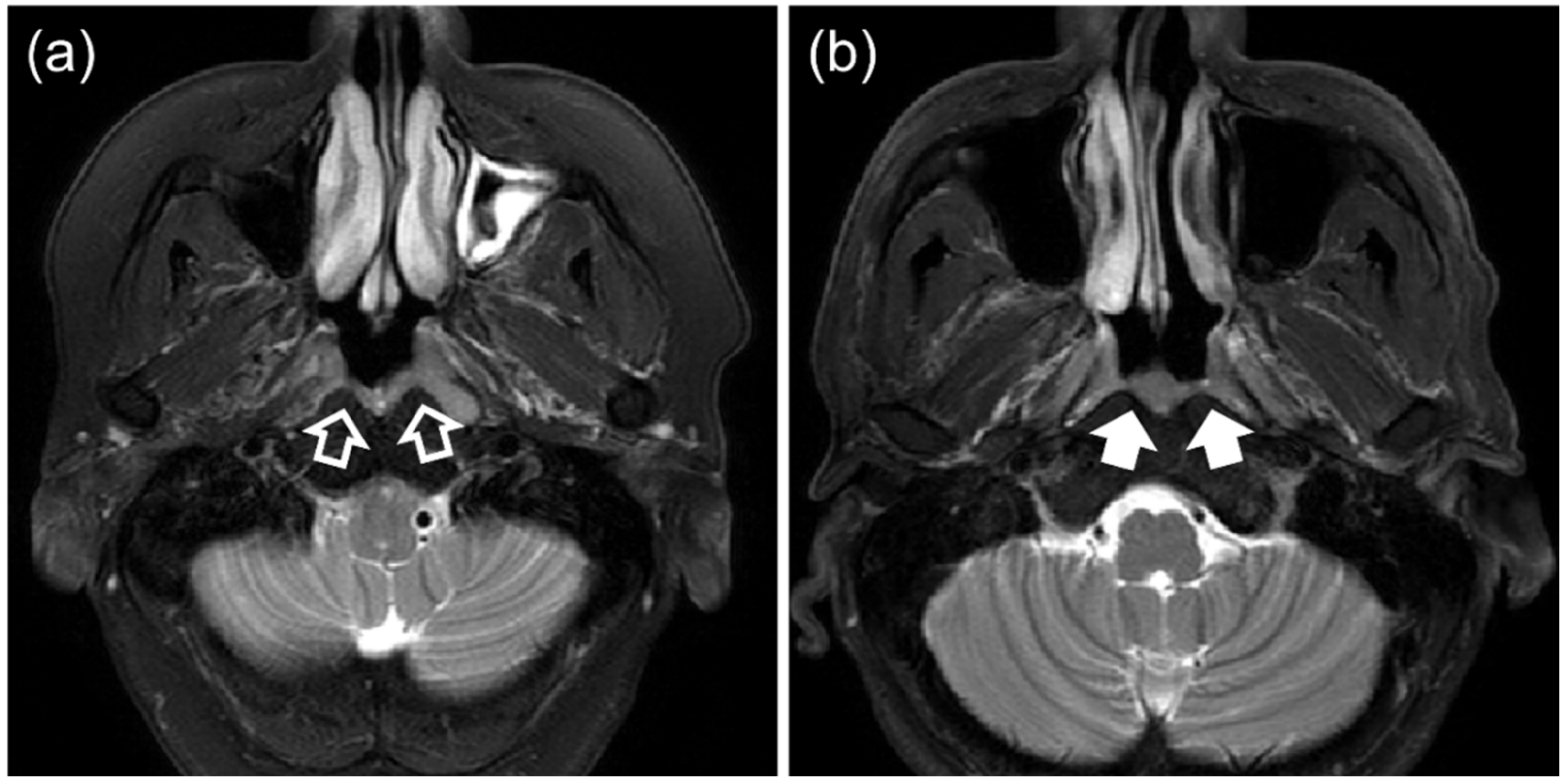 Nasopharyngeal Cancer Stage 4