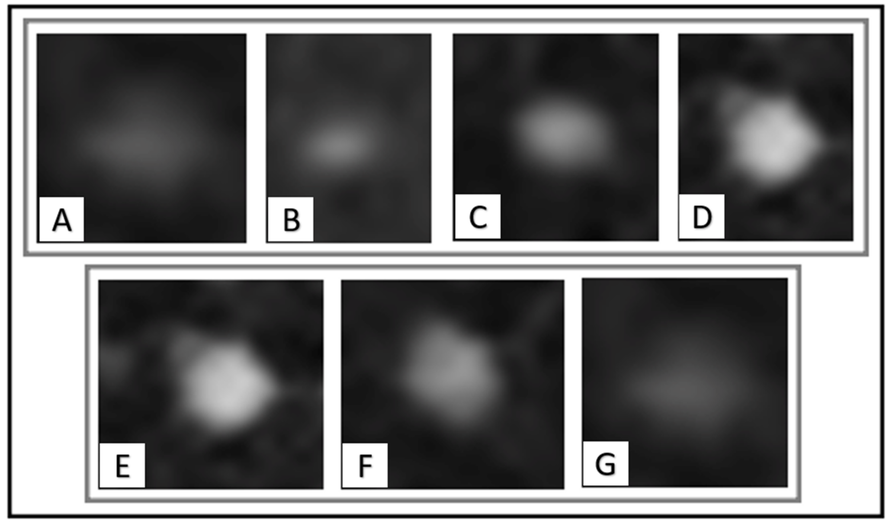 Lung Nodules Missed in Initial Staging of Breast Cancer Patients in PET ...