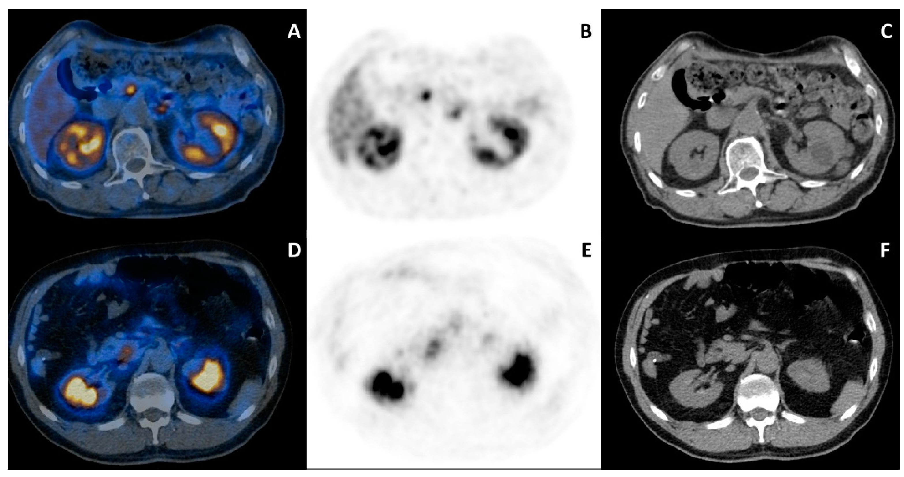 [68Ga]Ga-DOTANOC Uptake at Pancreatic Head/Uncinate Process: Is It a ...